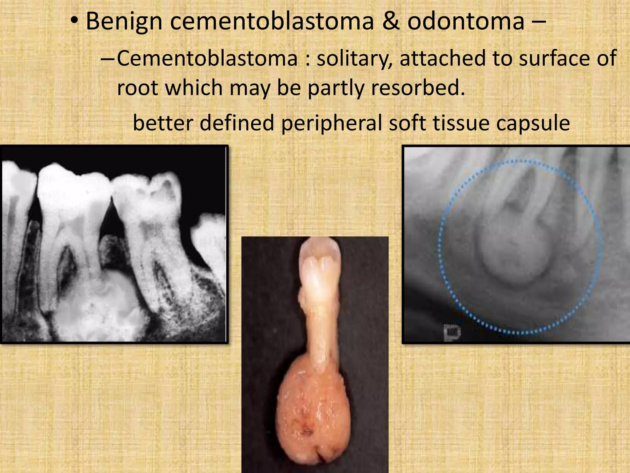 Mixed radiopaque & radiolucent lesions of jaw | PPTX