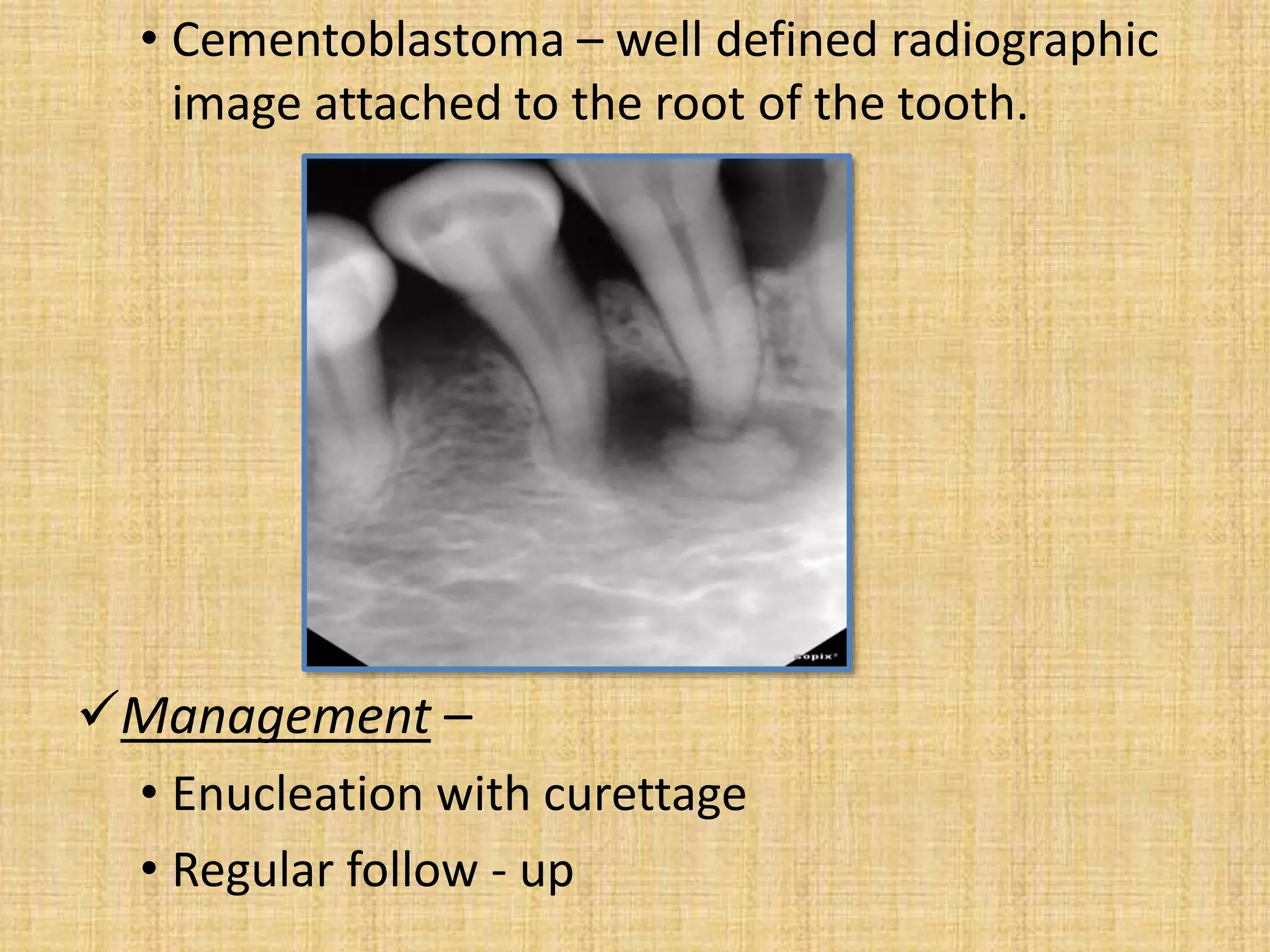 Mixed Radiopaque And Radiolucent Lesions Of Jaw Pptx