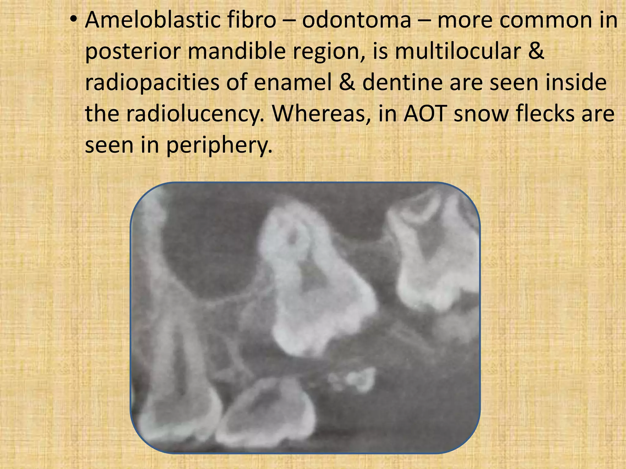 Mixed Radiopaque And Radiolucent Lesions Of Jaw Pptx