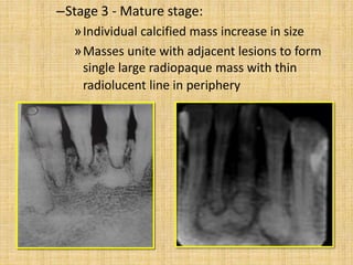 Mixed radiopaque & radiolucent lesions of jaw | PPTX