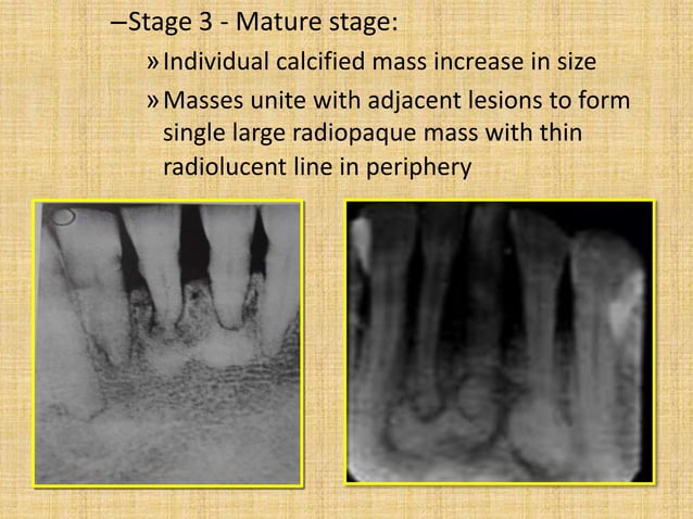 Mixed radiopaque & radiolucent lesions of jaw | PPTX | Dental Health ...