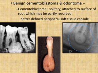 Mixed radiopaque & radiolucent lesions of jaw | PPTX