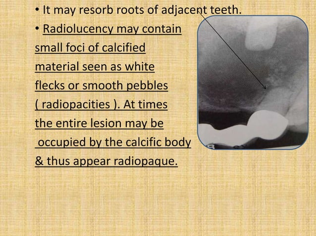 Mixed radiopaque & radiolucent lesions of jaw | PPTX | Dental Health | Diseases and Conditions
