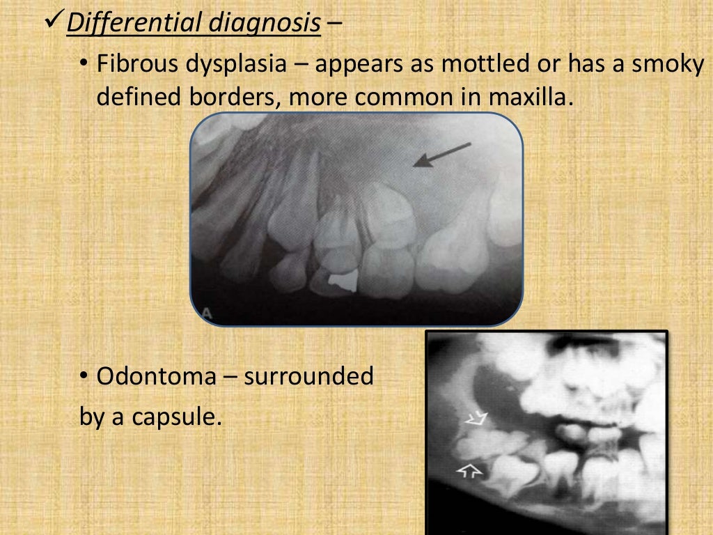 Mixed Radiopaque And Radiolucent Lesions Of Jaw