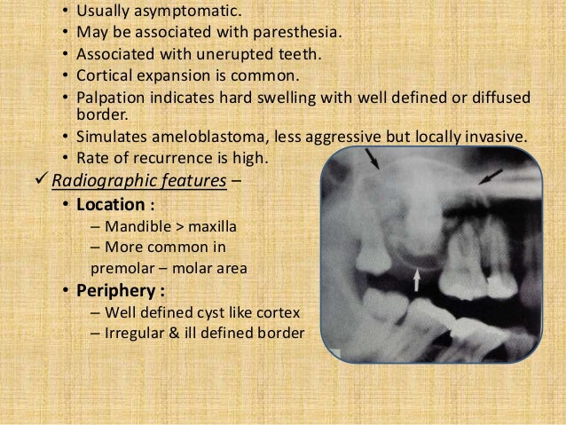 Mixed radiopaque & radiolucent lesions of jaw