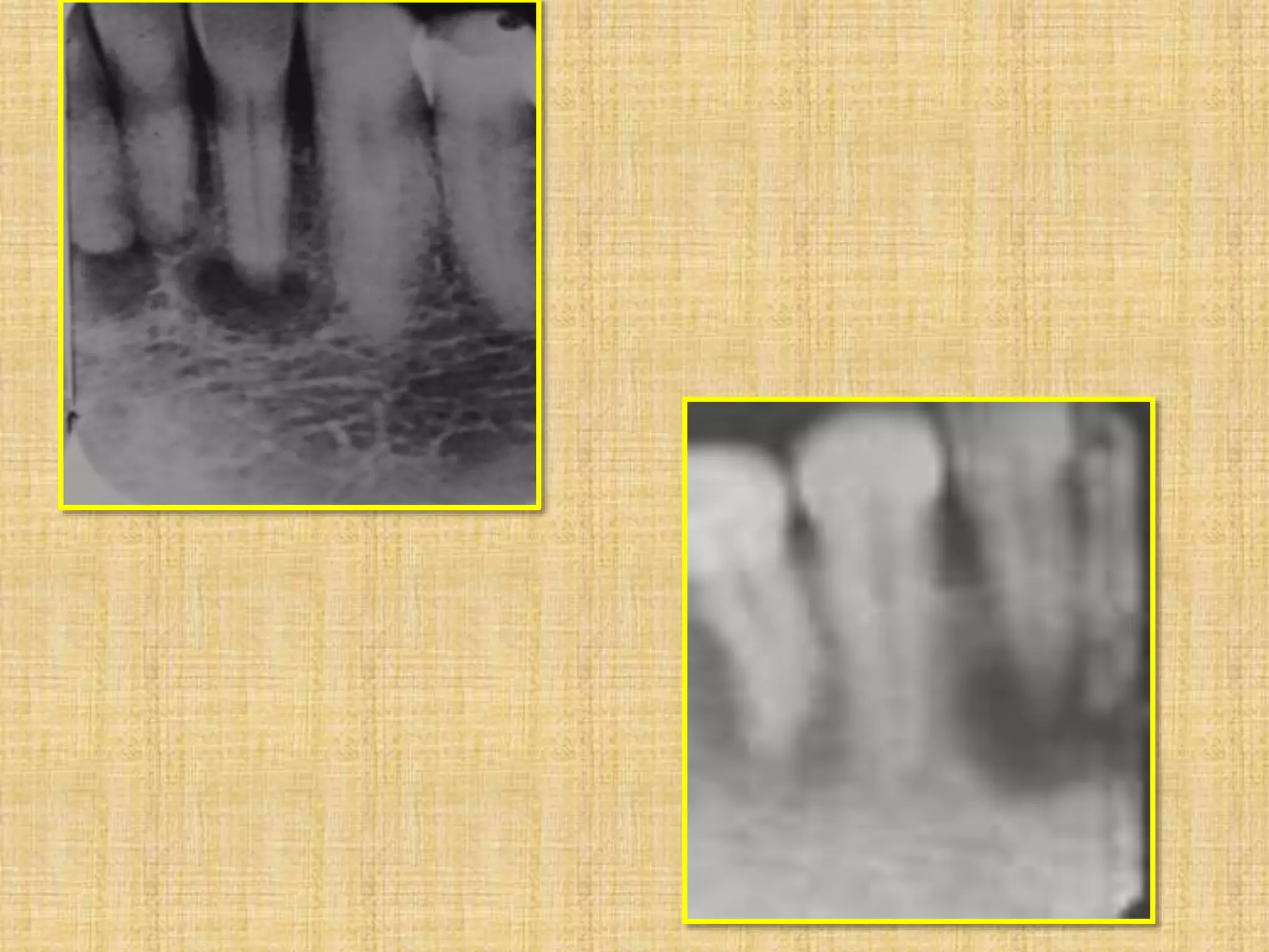 Mixed radiopaque & radiolucent lesions | PPTX