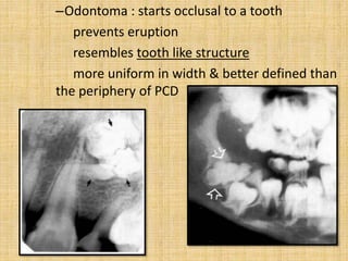Mixed radiopaque & radiolucent lesions | PPTX