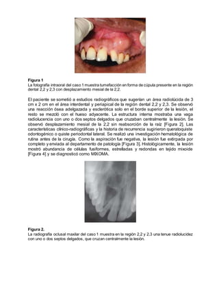 MIXOMA ODONTOGENICO DEL MAXILAR: DISCUSION Y REVISION CON DOS REPORTES ...