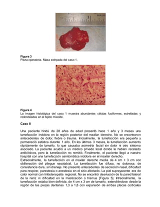 MIXOMA ODONTOGENICO DEL MAXILAR: DISCUSION Y REVISION CON DOS REPORTES ...