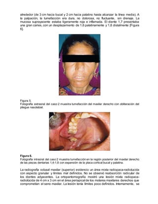 MIXOMA ODONTOGENICO DEL MAXILAR: DISCUSION Y REVISION CON DOS REPORTES ...