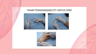 mixsafe dan nasal prong rev.pptx