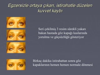 Miyastenia gravis | PPT