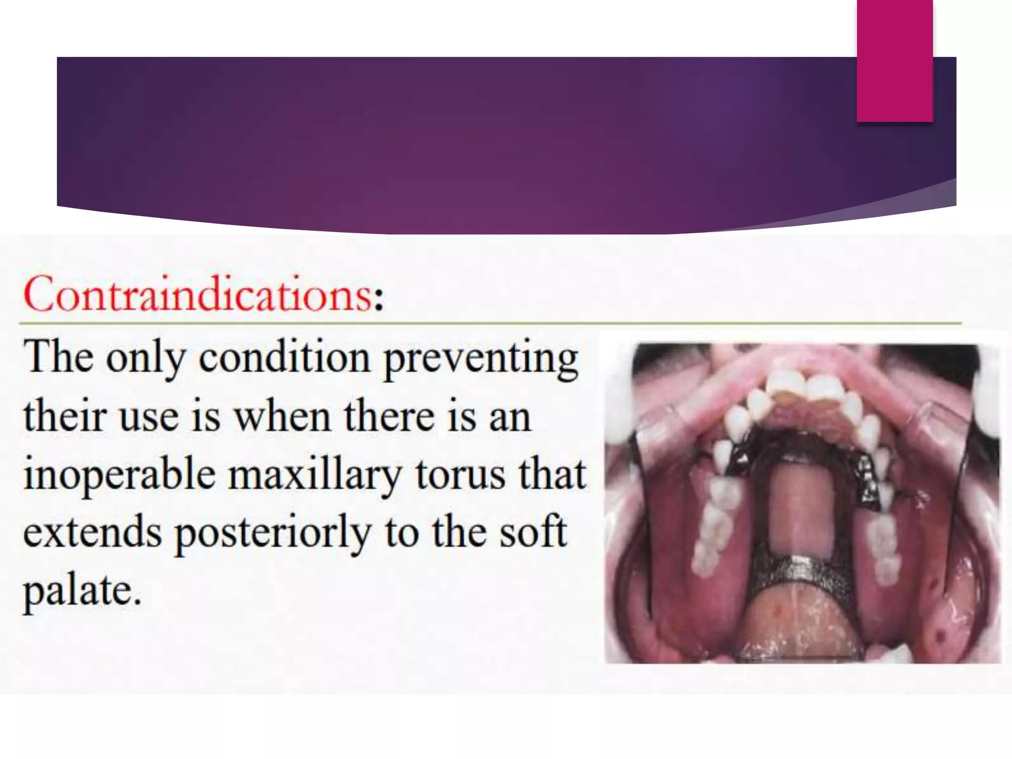 Maxillary & Mandibular Major Connectors.pptx