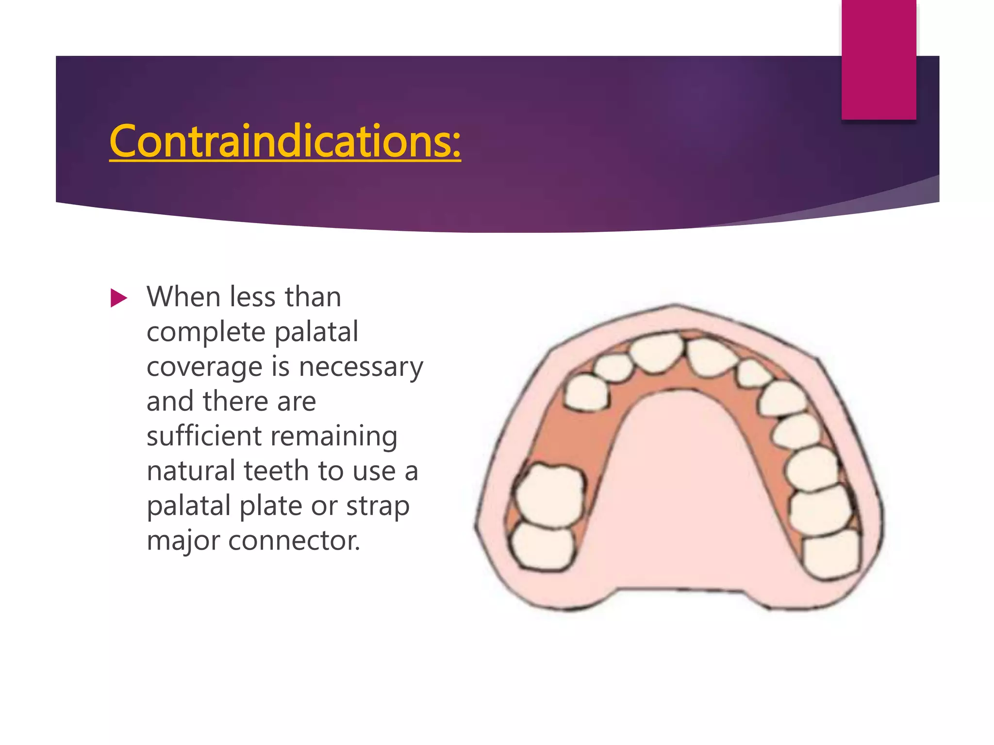 Maxillary & Mandibular Major Connectors.pptx