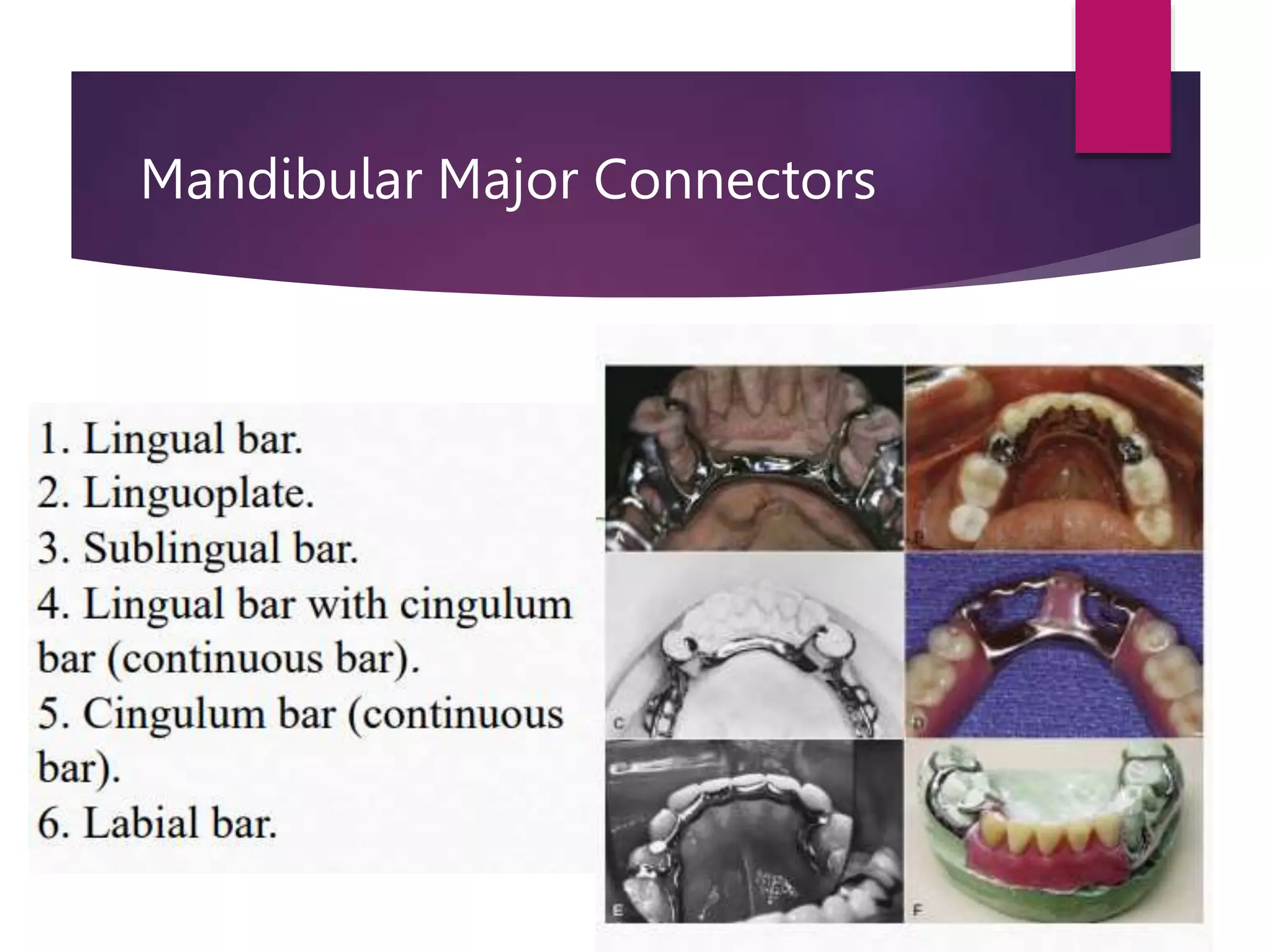 Maxillary & Mandibular Major Connectors.pptx