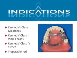Maxillary & Mandibular Major Connectors.pptx