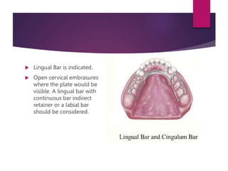 Maxillary & Mandibular Major Connectors.pptx