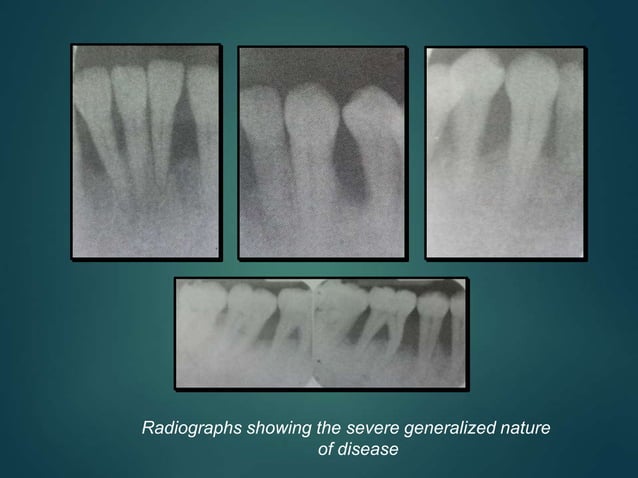 Gingivitis Vs Periodontitis | PPTX | Oral care | Personal Care