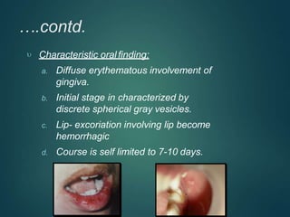 Gingivitis Vs Periodontitis | PPTX