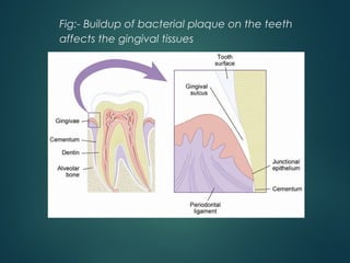 gingival and periodontal diseases | PPT