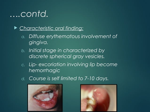 Gingival And Periodontal Diseases Ppt Dental Health Diseases And