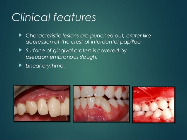 gingival and periodontal diseases