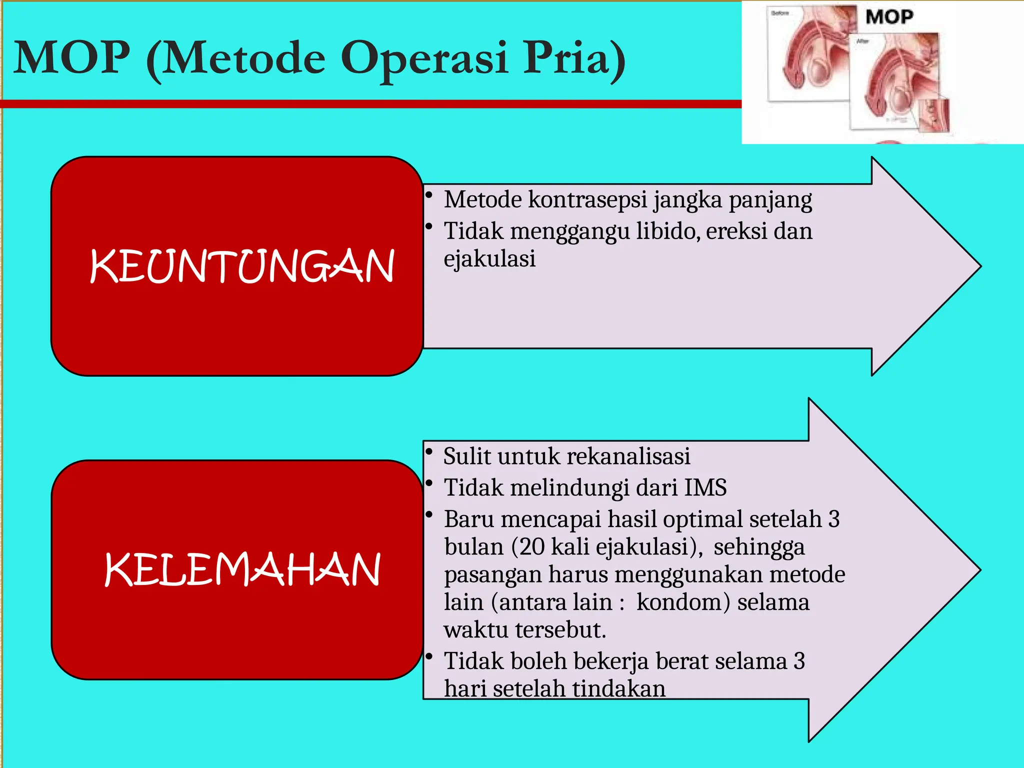 Metode Pemilihan KB Jangka Panjang..pptx