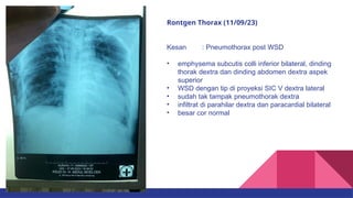 MK Pneumothorax pneumothorax thorax yess | PPTX