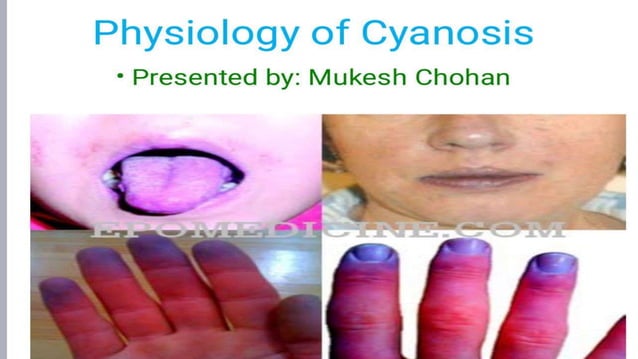 Physiology of cyanosis presentation.pptx