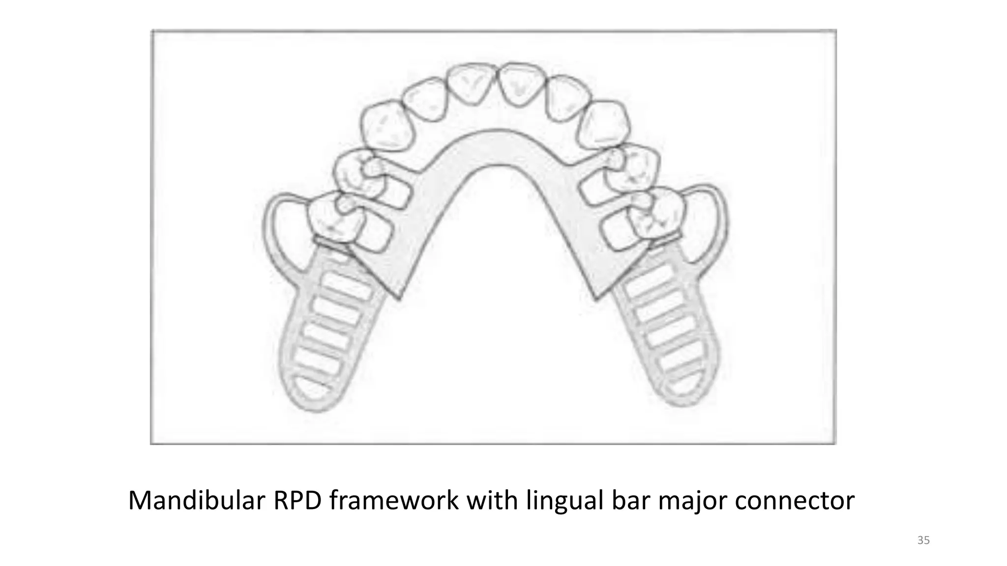 Practical Points of View for Removable Partial Denture | PPTX