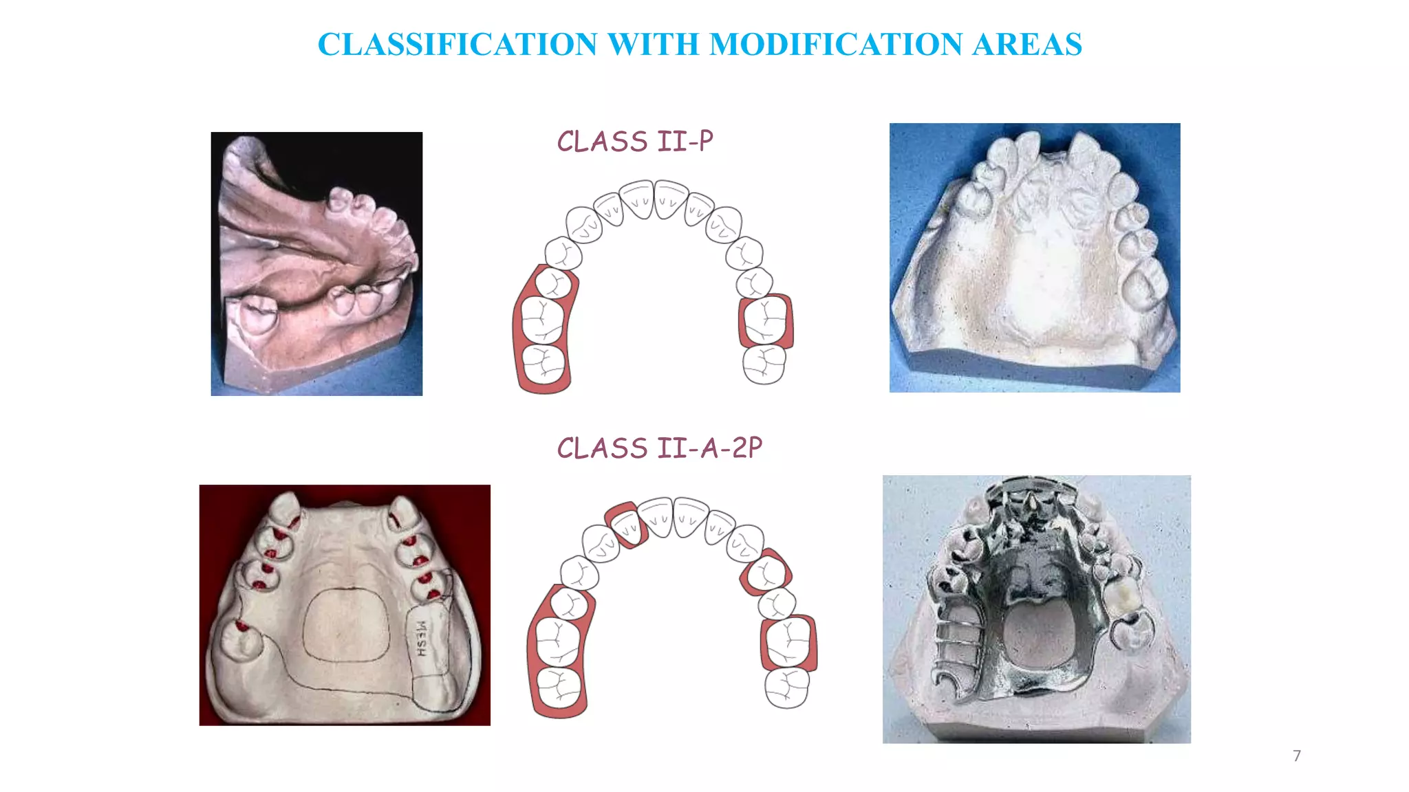 Practical Points of View for Removable Partial Denture | PPTX