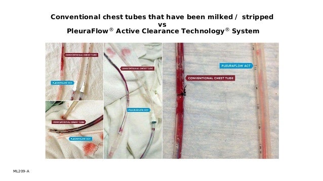 Conventional Chest Tubes that have been Milked / Stripped vs PleuraFl…