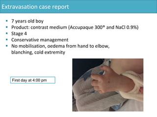 Mld and extravasation | PDF