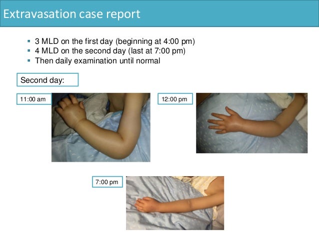 Mld and extravasation