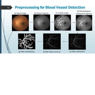 ML edddddddddddddddddddddddddxduated detection.pptx