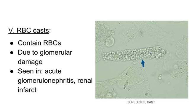 Urine: Microscopic examination - Pathology - MLT, ATOT, RDT | PPTX ...