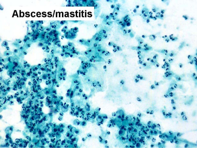 Mlt cyto breast mastitis fat necrosis