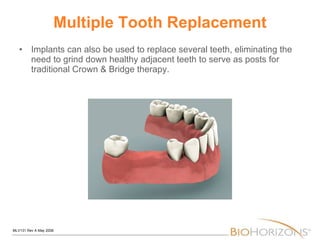 Dental Implants - The Tooth Replacement Solution | PPT