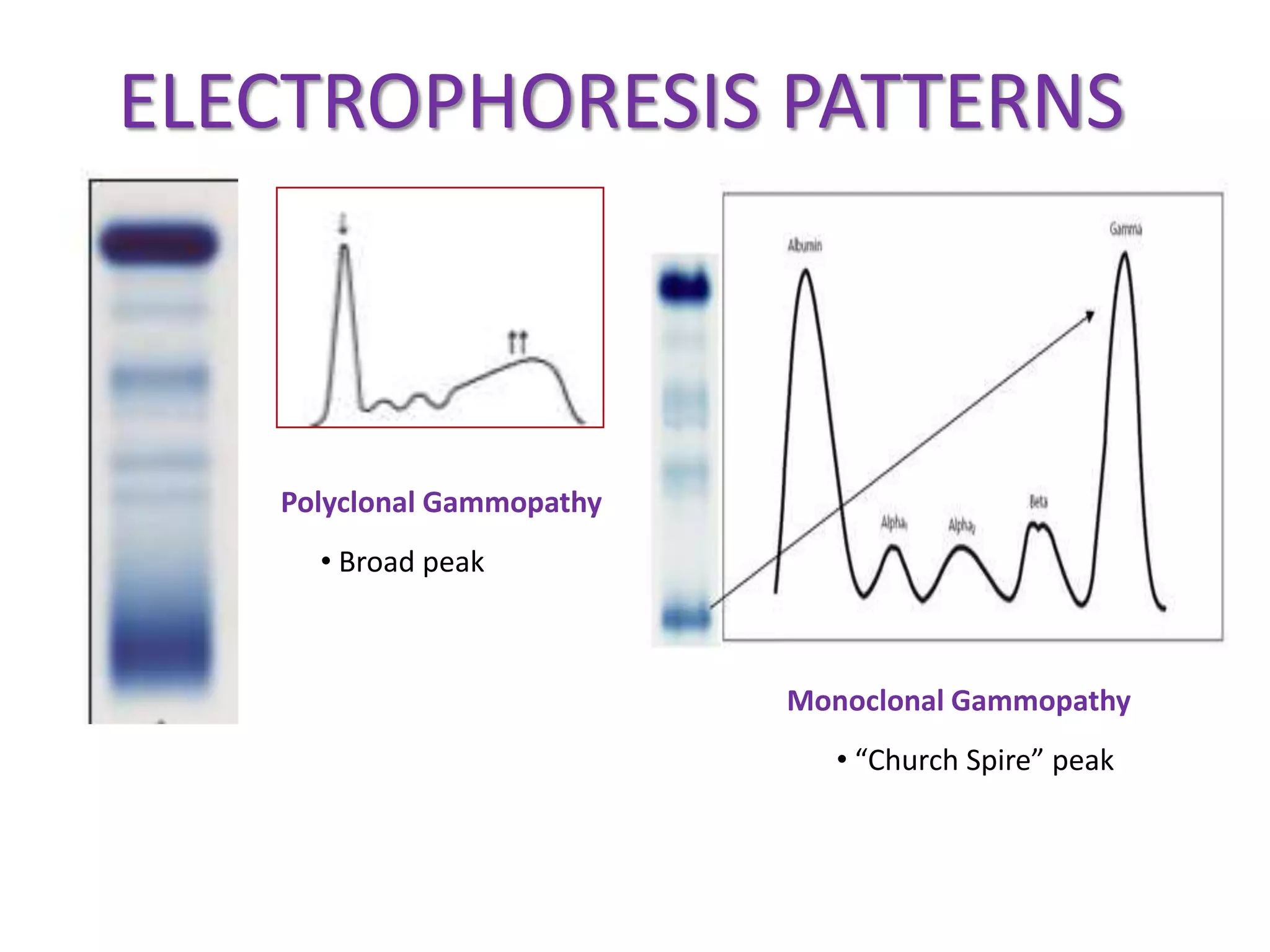 Multiple Myeloma | PPTX