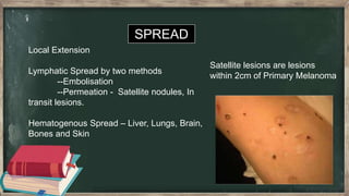 Malignant Melanoma Presentation Seminar. | PPTX | Cancer | Diseases and ...