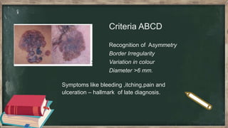 Malignant Melanoma Presentation Seminar. | PPTX | Cancer | Diseases and ...