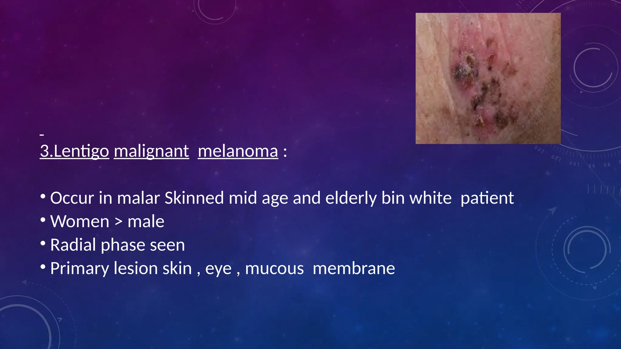 Bds 3rd Malignant melanoma.ppt