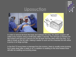 0854746 Plastic Surgery | PPT