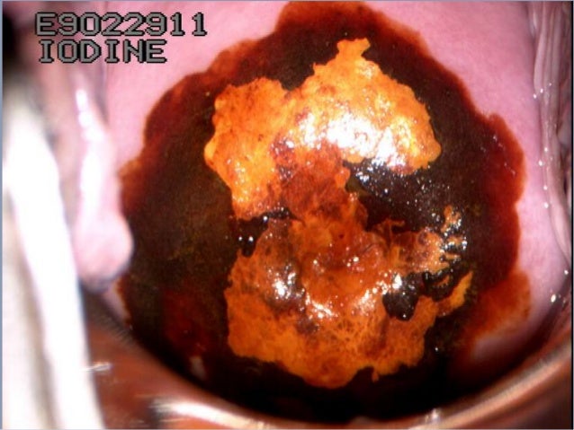 3 prof walter colposcopic