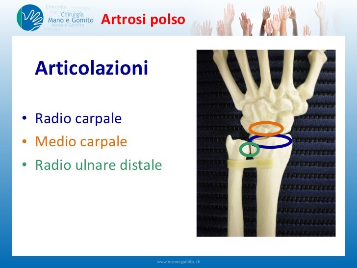 Artrosi del polso: diagnosi e terapie