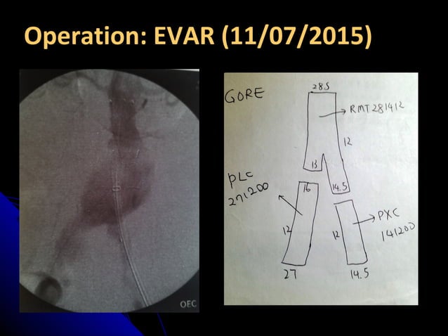 M & M for bowel ischemia after EVAR | PPT | Digestive Disorders ...