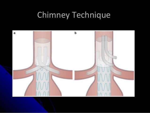 M & M for bowel ischemia after EVAR