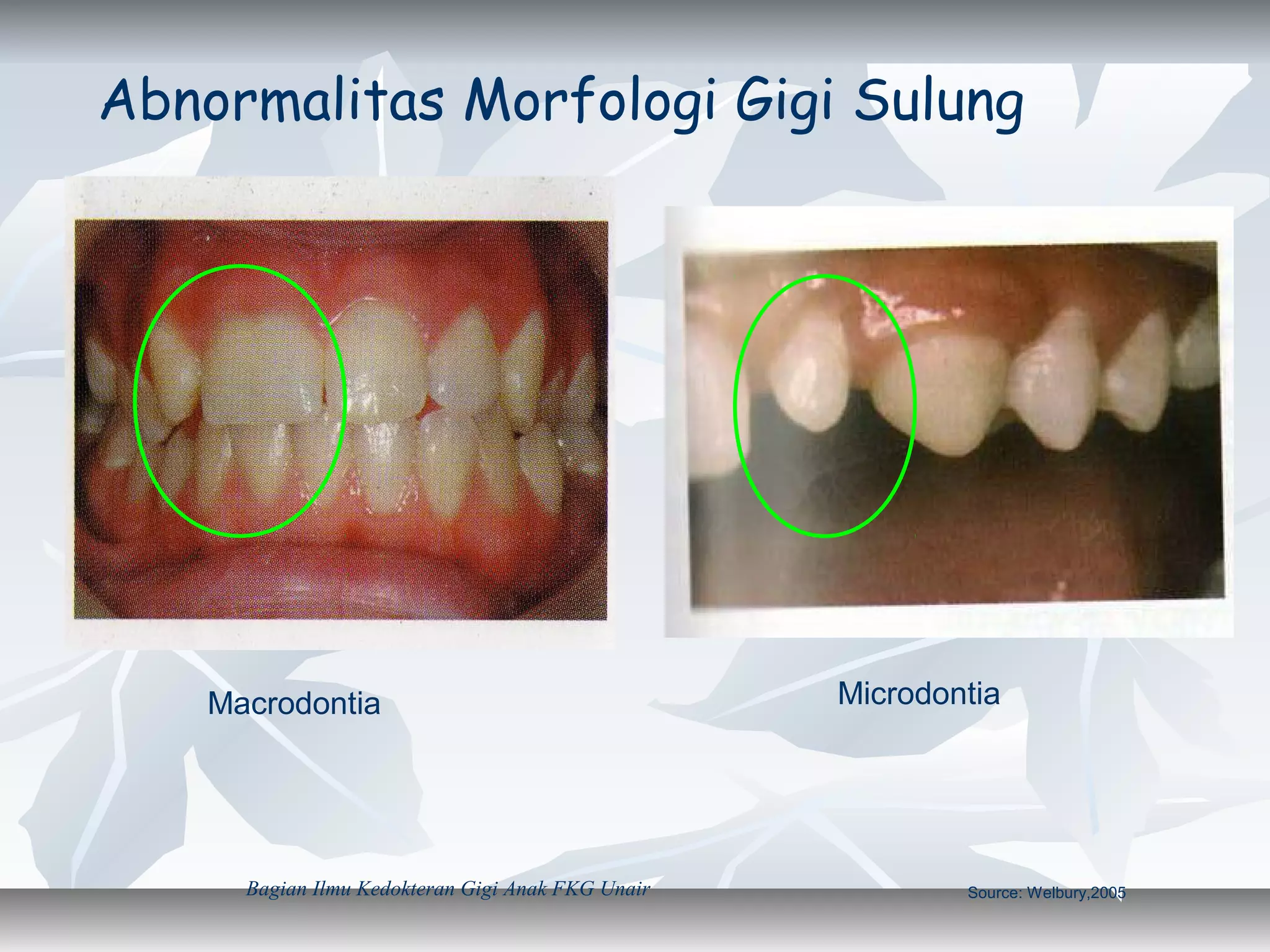 Mmp morfologi gigi sulung | PPT