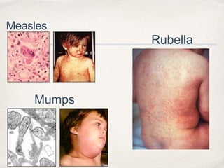 Mumps Rash