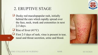 MEASLES MUMPS RUBELLA, PPT FOR EDUCATION | PPTX